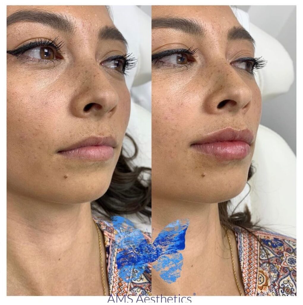 How To Get Bigger Lips Naturally or With Fillers | AMS