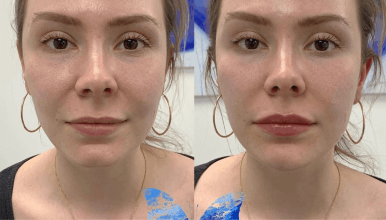 How To Get Bigger Lips Naturally or With Fillers | AMS