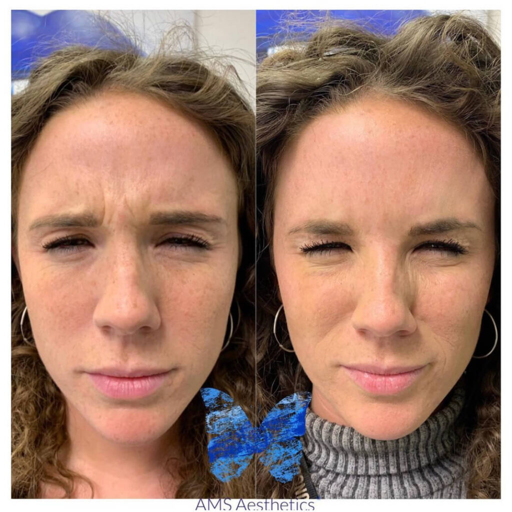 How to Get Rid of Forehead Wrinkles & Lines | AMS Aesthetics