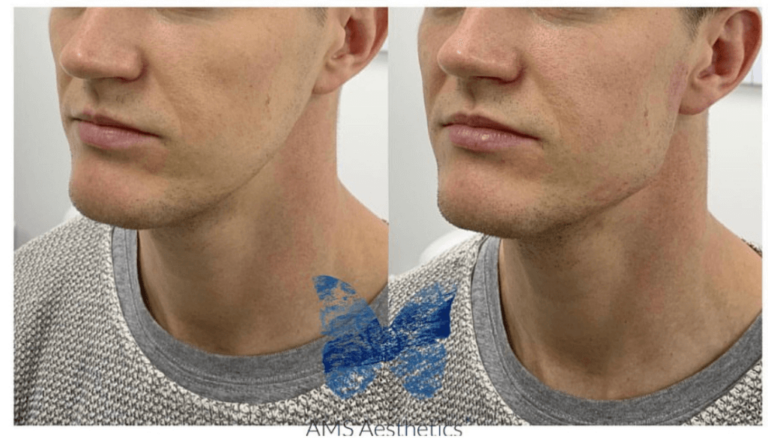 Jawline Contouring: Best Ways to Contour Jawline | AMS Aesthetics