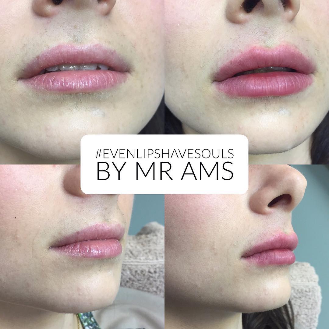 1ml Lip Filler Before & After Thin lips: Realistic Results | AMS Aesthetics
