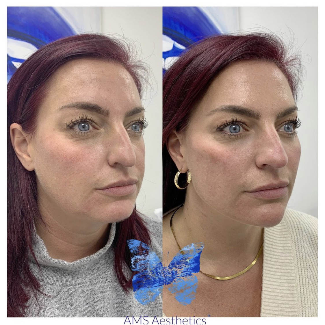 Chin FIllers | Non-Surgical Chin Augmentation - London