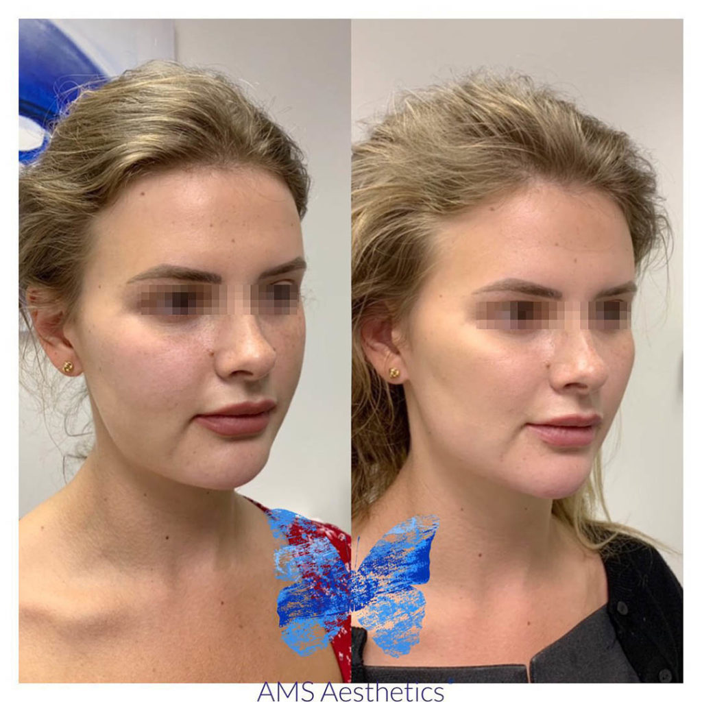 Cheek Fillers | Cheek Enhancement London, UK - AMS Aesthetics