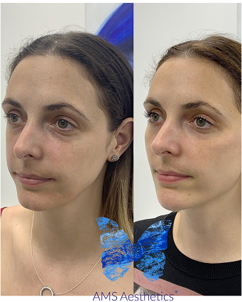 Cheek Fillers London | Cost, Before & After | AMS Aesthetics